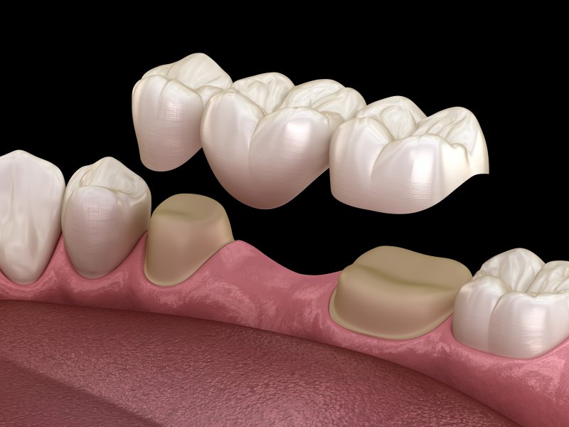 What to Do If Your Dental Bridge Falls Out - Windermere Dentistry Blog
